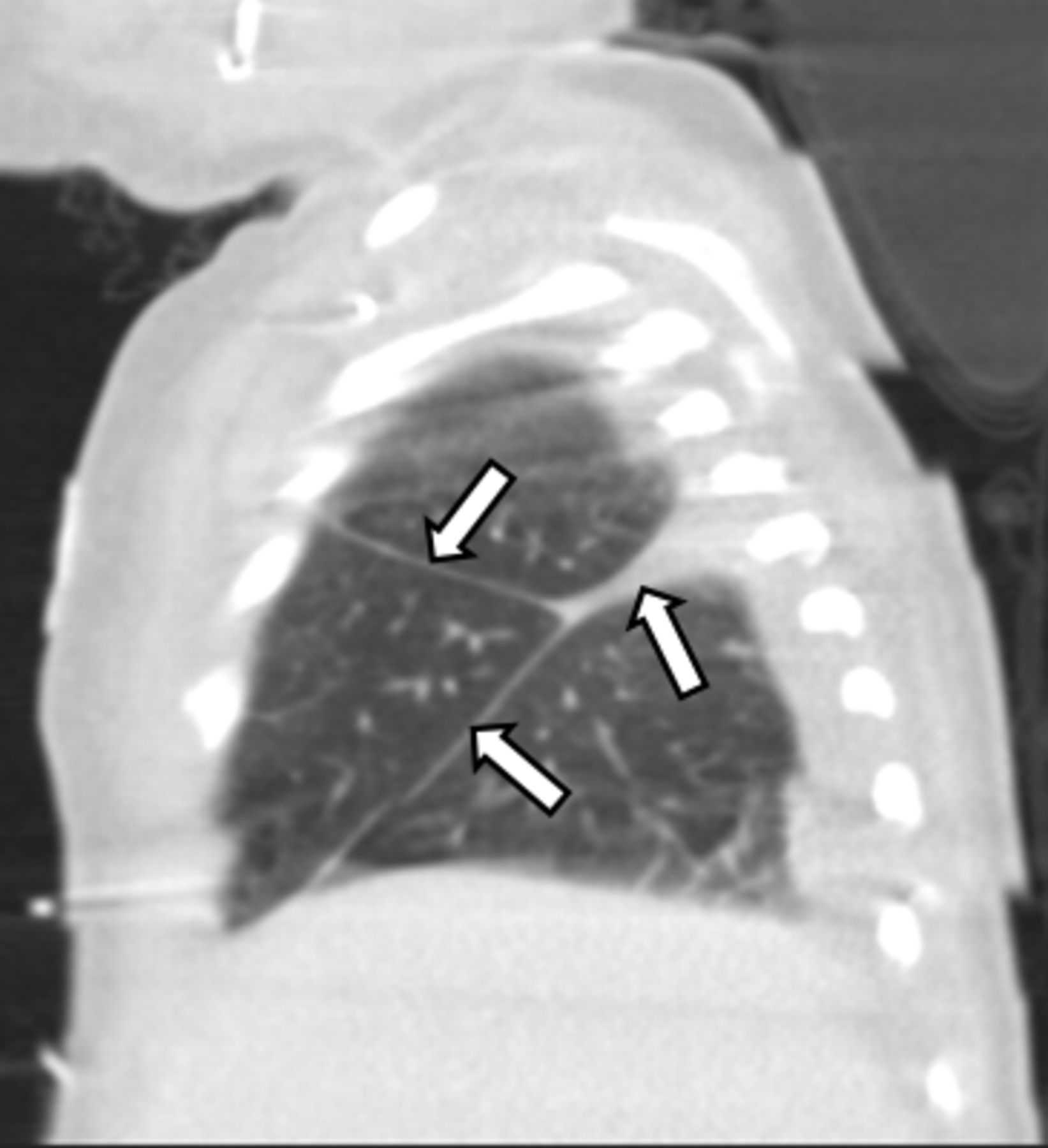Visualization of pleural fissures in infants on computed tomography ...