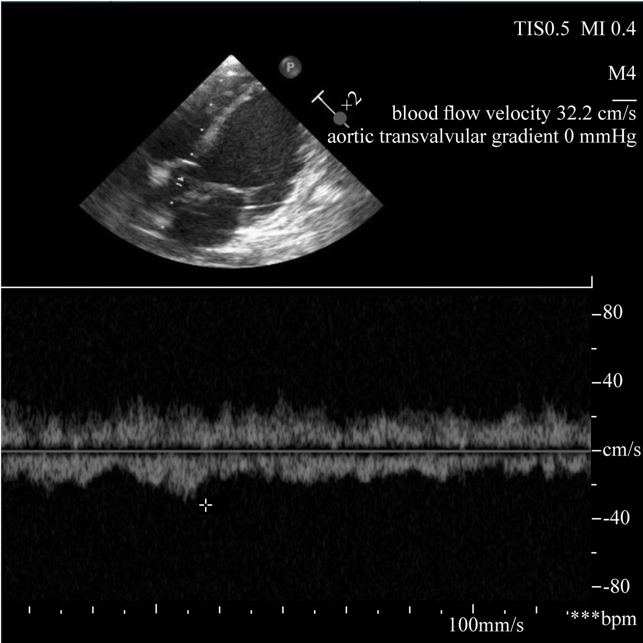 Surgical minimal invasive left atrial decompression during venoarterial ...