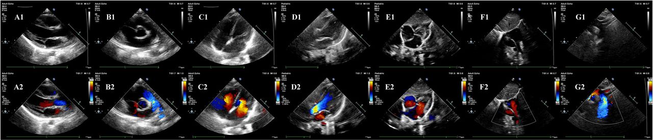 A deep learning-based method for pediatric congenital heart disease ...