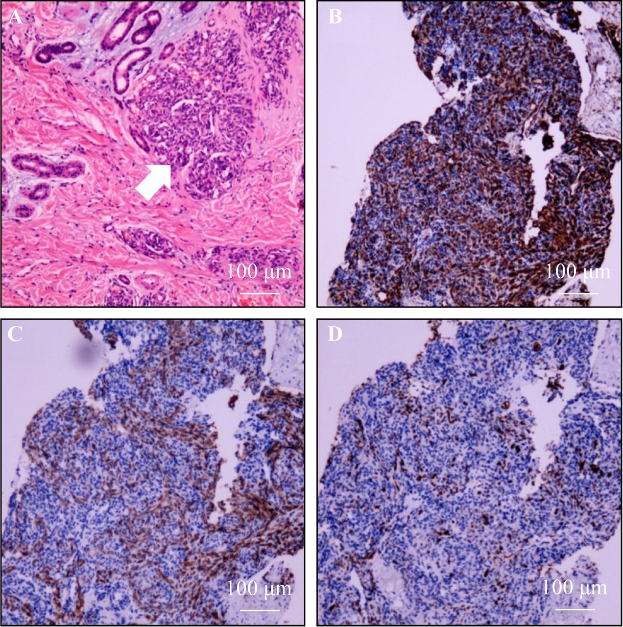 Unique Cobb syndrome with Kaposi hemangioendothelioma/tufted angioma as ...