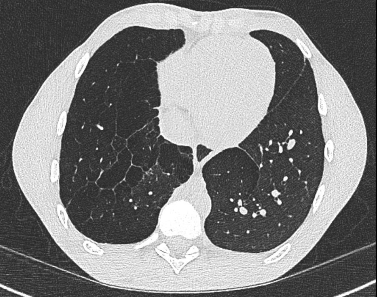 Emphysema Radiology