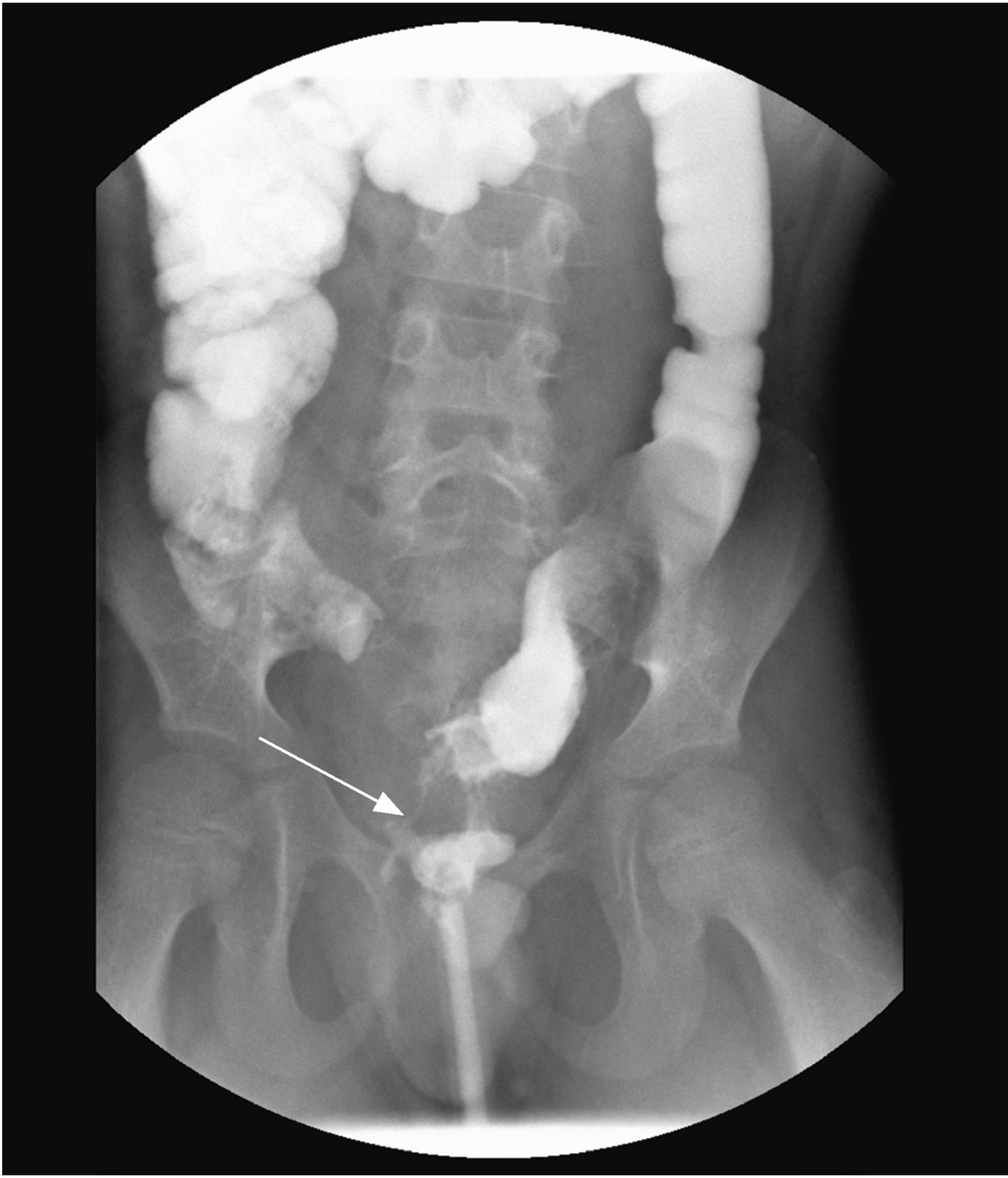 Pullthrough pitfalls in treating Hirschsprung disease | World Journal ...