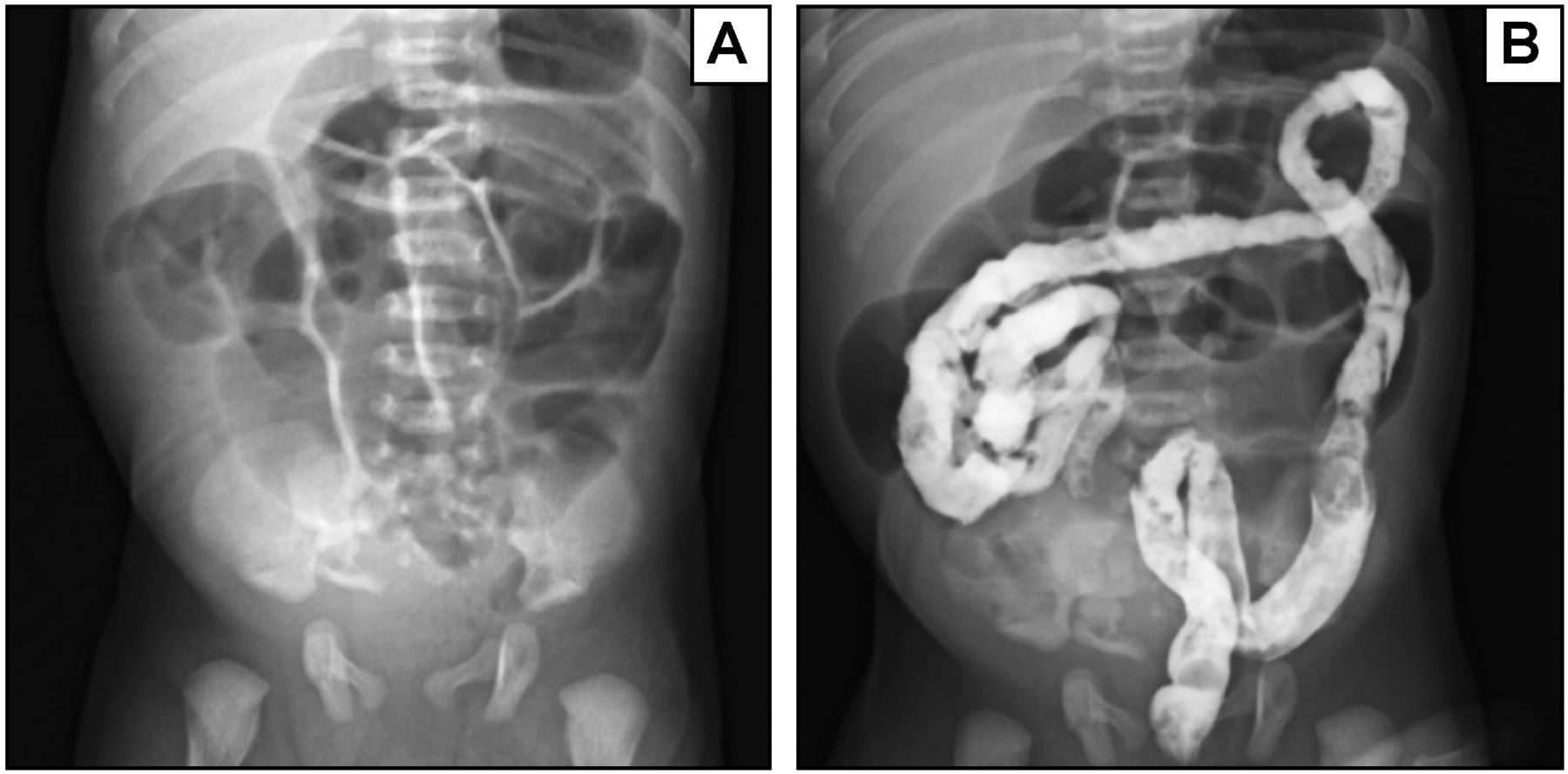 Conditions that mimic Hirschsprung’s disease, but that are not ...