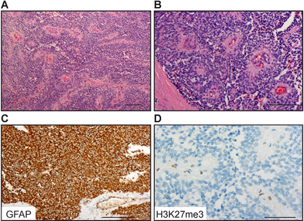 Thoracic metastasis of a pediatric posterior fossa group A ependymoma ...